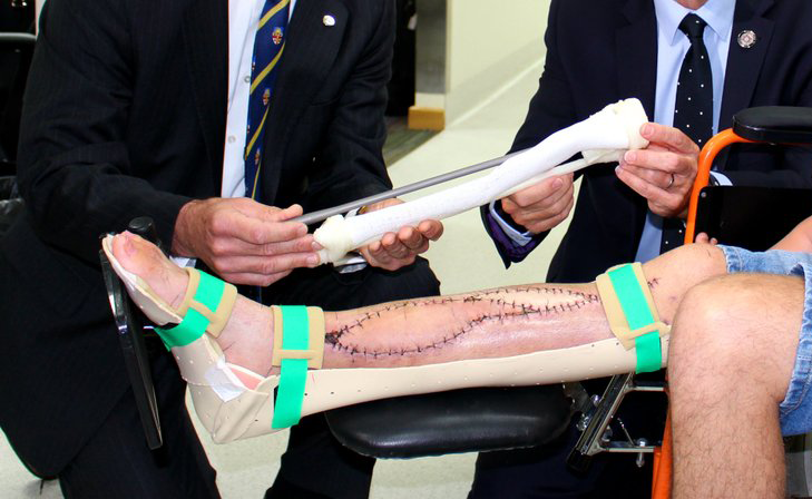 Qld surgeons successfully transplant 3D printed shinbone to save ...