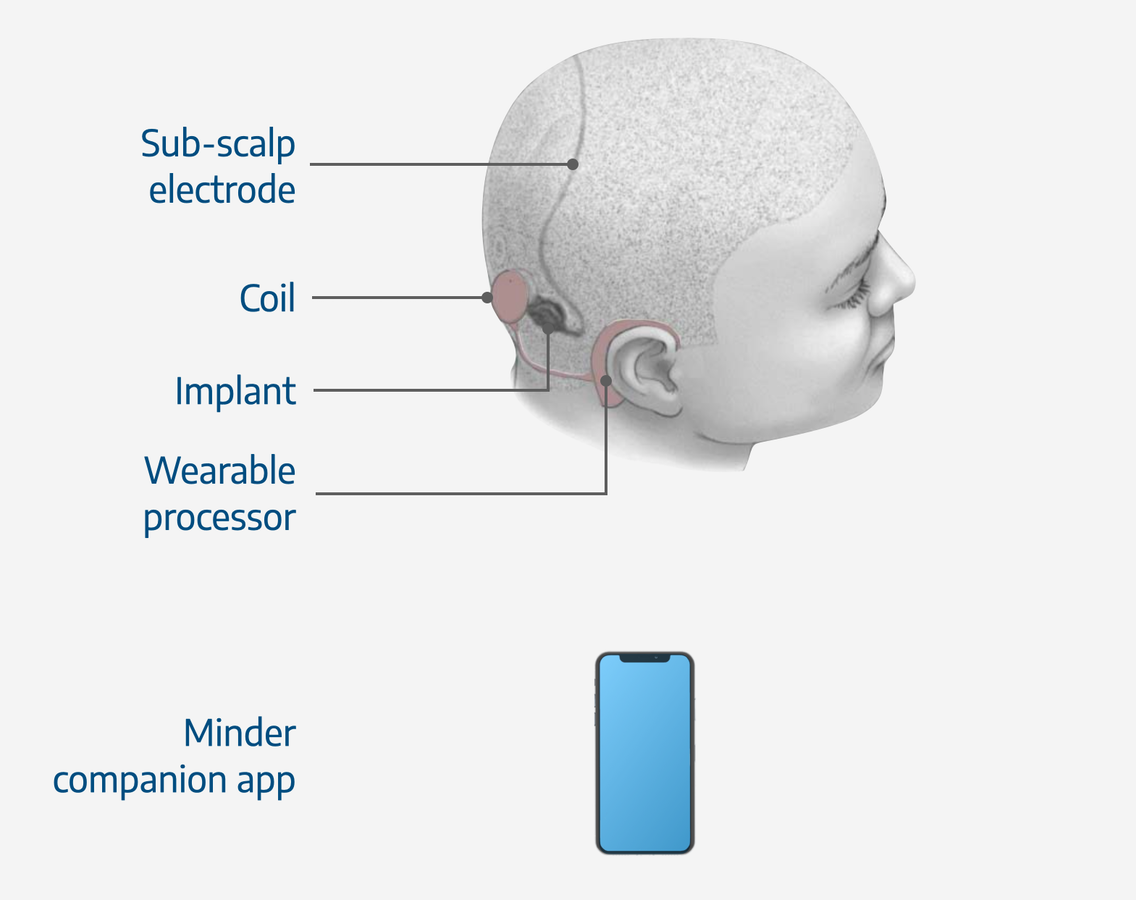 Cochlear-backed Aussie innovator raises $16m to test seizure epilepsy ...